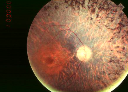 Les rétinites pigmentaires - SOS RETINITE